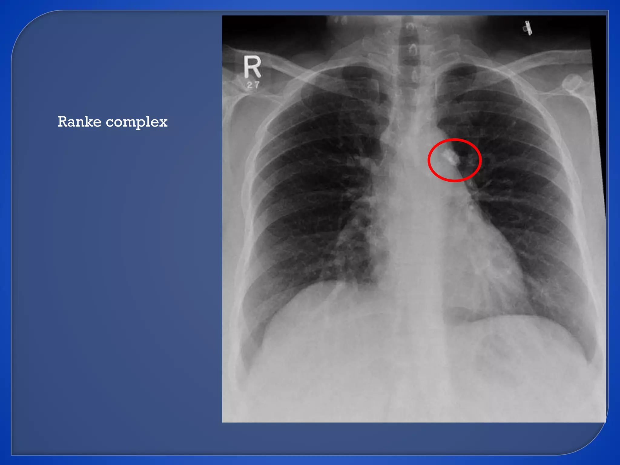 tuberculosis viral infections mediastinum radiology | PPTX