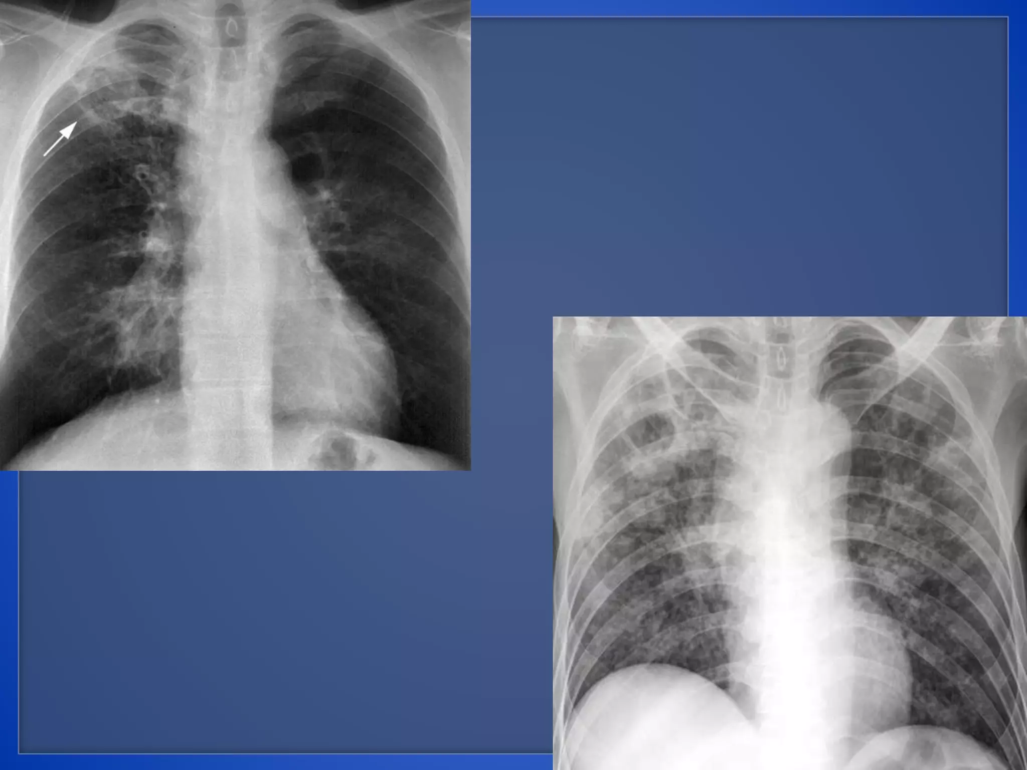 tuberculosis viral infections mediastinum radiology | PPTX