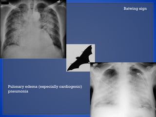 tuberculosis viral infections mediastinum radiology | PPTX