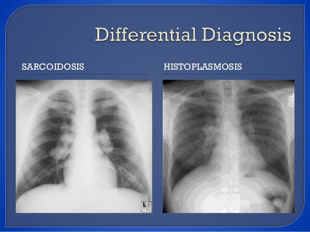 tuberculosis viral infections mediastinum radiology