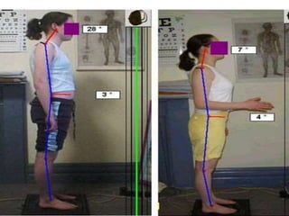 Forward head posture | PPTX