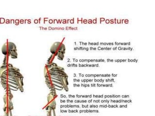 Forward head posture | PPTX