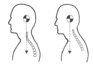 Forward head posture | PPTX