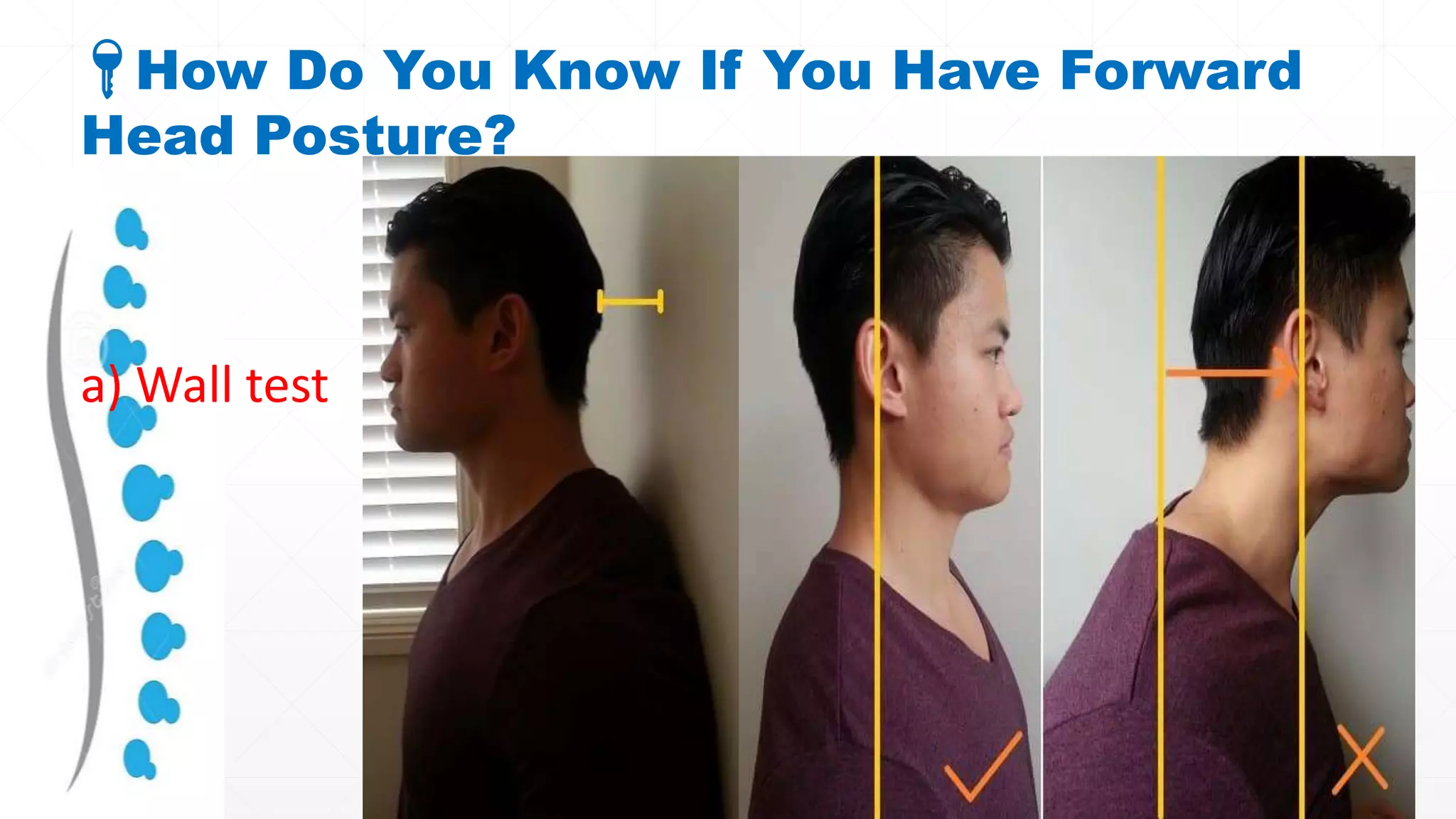 Forward head posture-causes | muscle pain symptoms | diagnosis ...