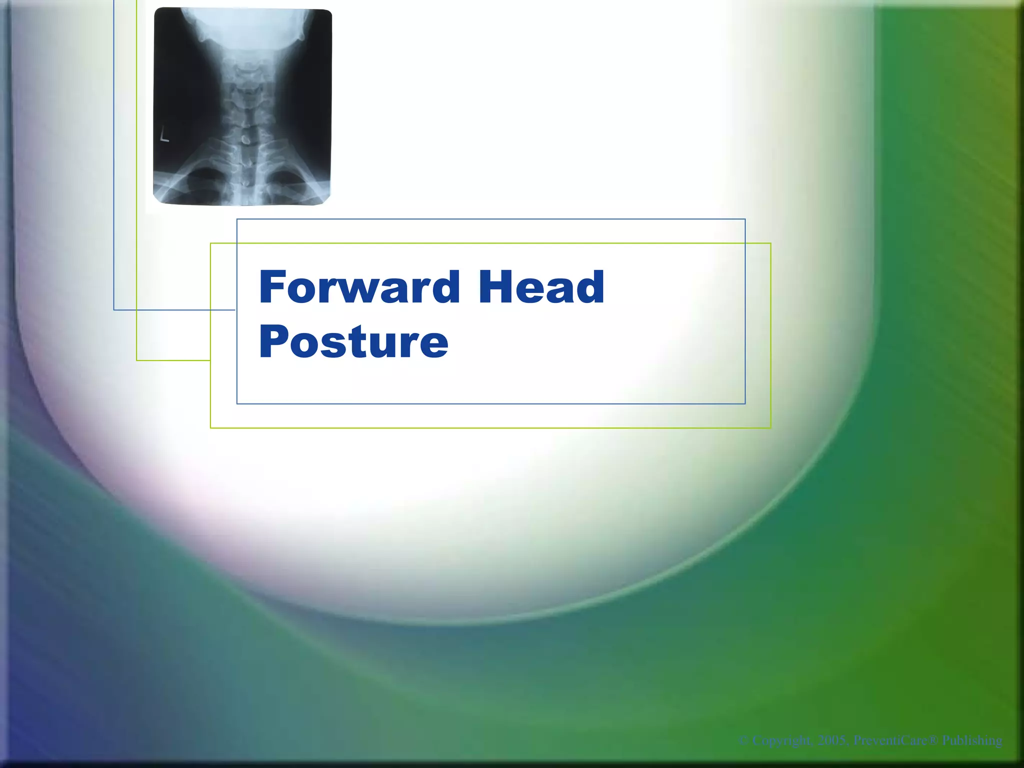 Forward Head Posture Powerpoint | PPT
