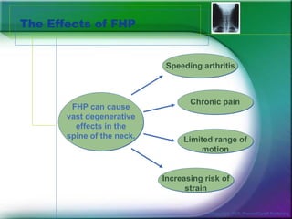 Forward Head Posture Powerpoint | PPT