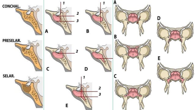 Fosa craneal media | PPT