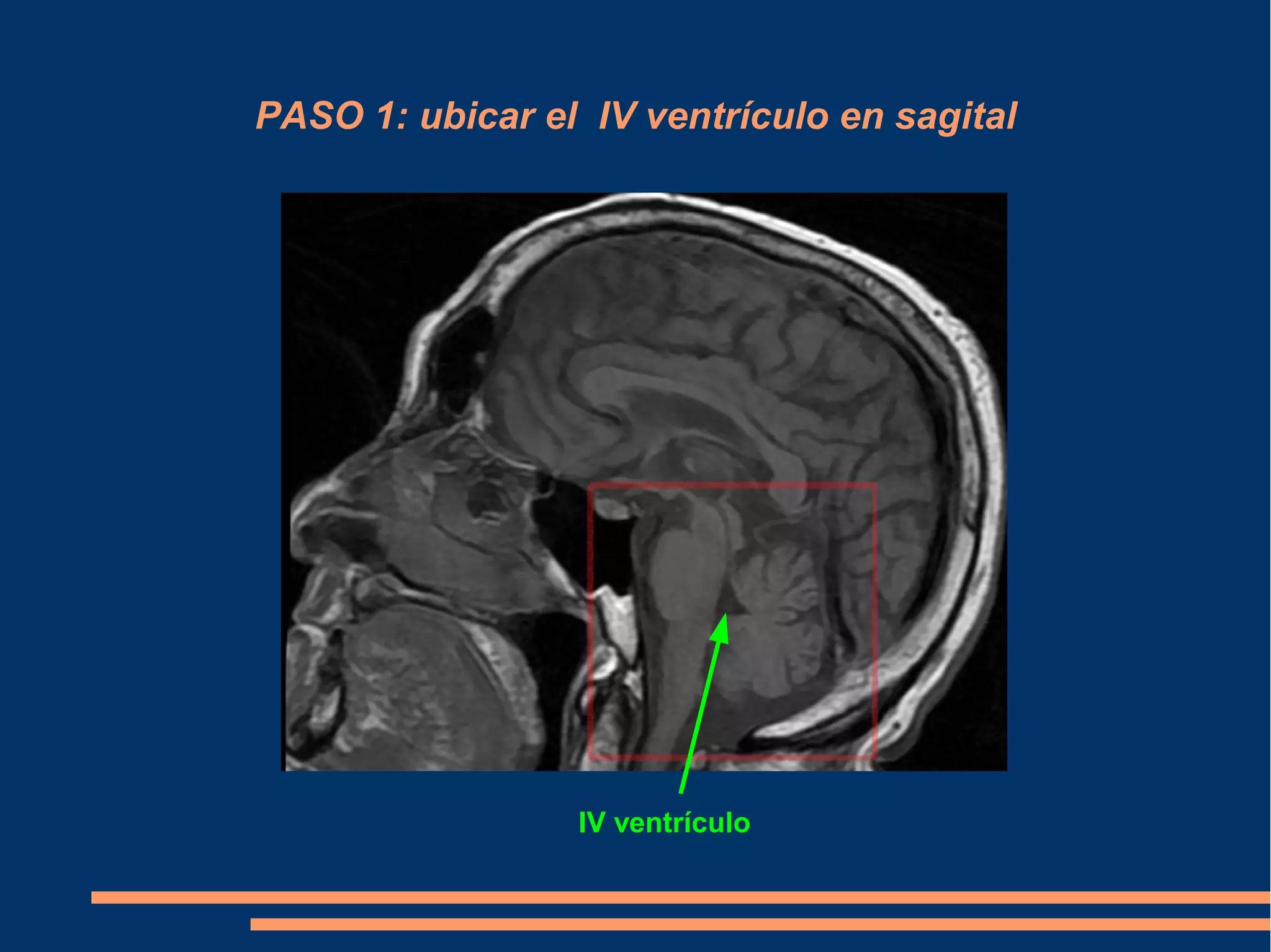 Fosa posterior rmn (1) | PDF | Brain and Nervous System Disorders ...