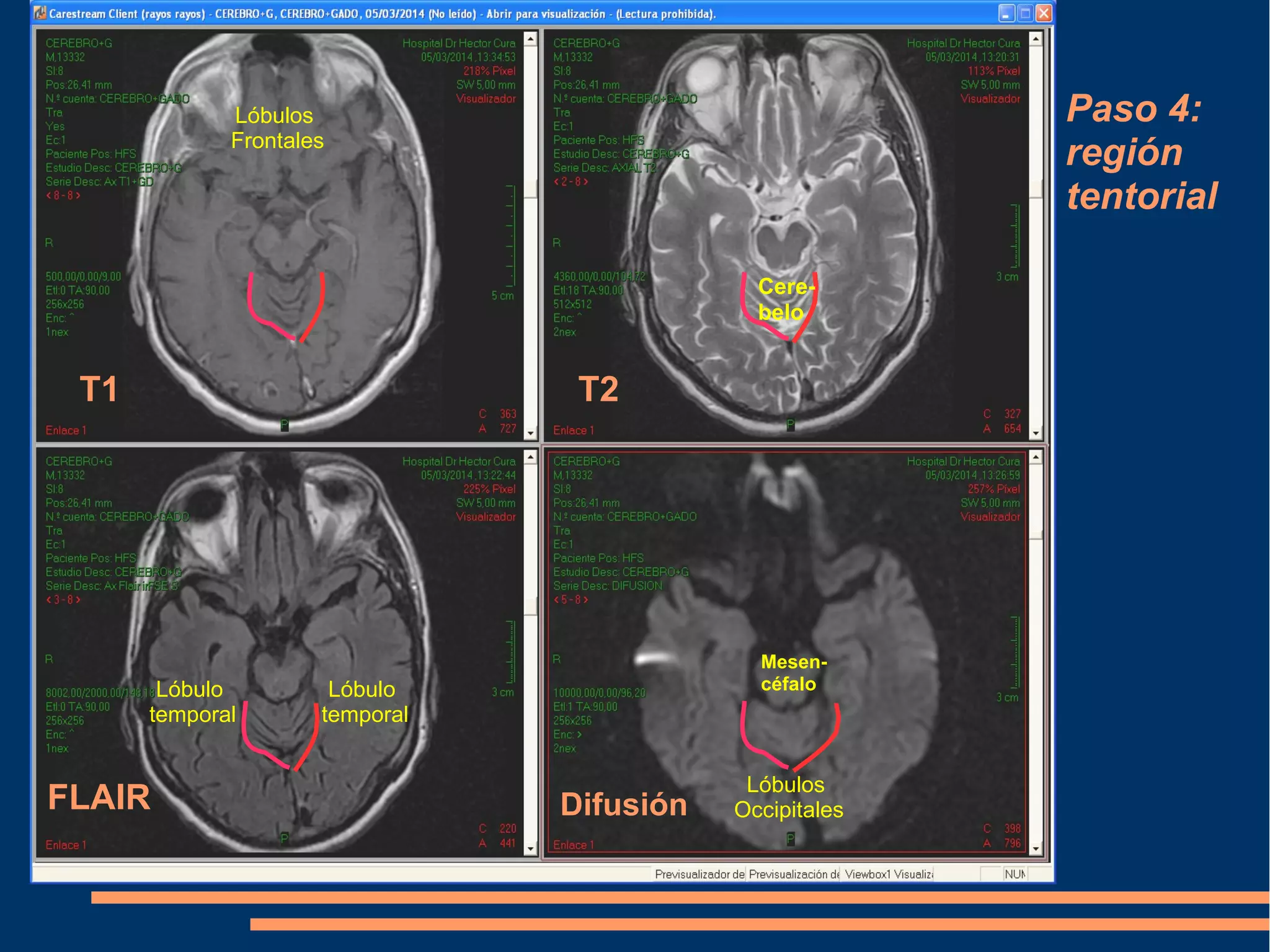 Fosa posterior rmn (1) | PPT