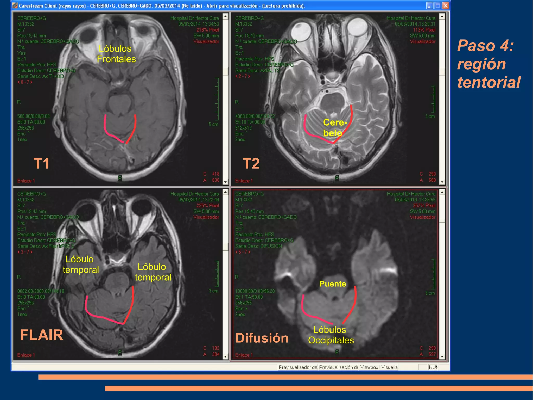 Fosa posterior rmn (1) | PDF | Brain and Nervous System Disorders ...