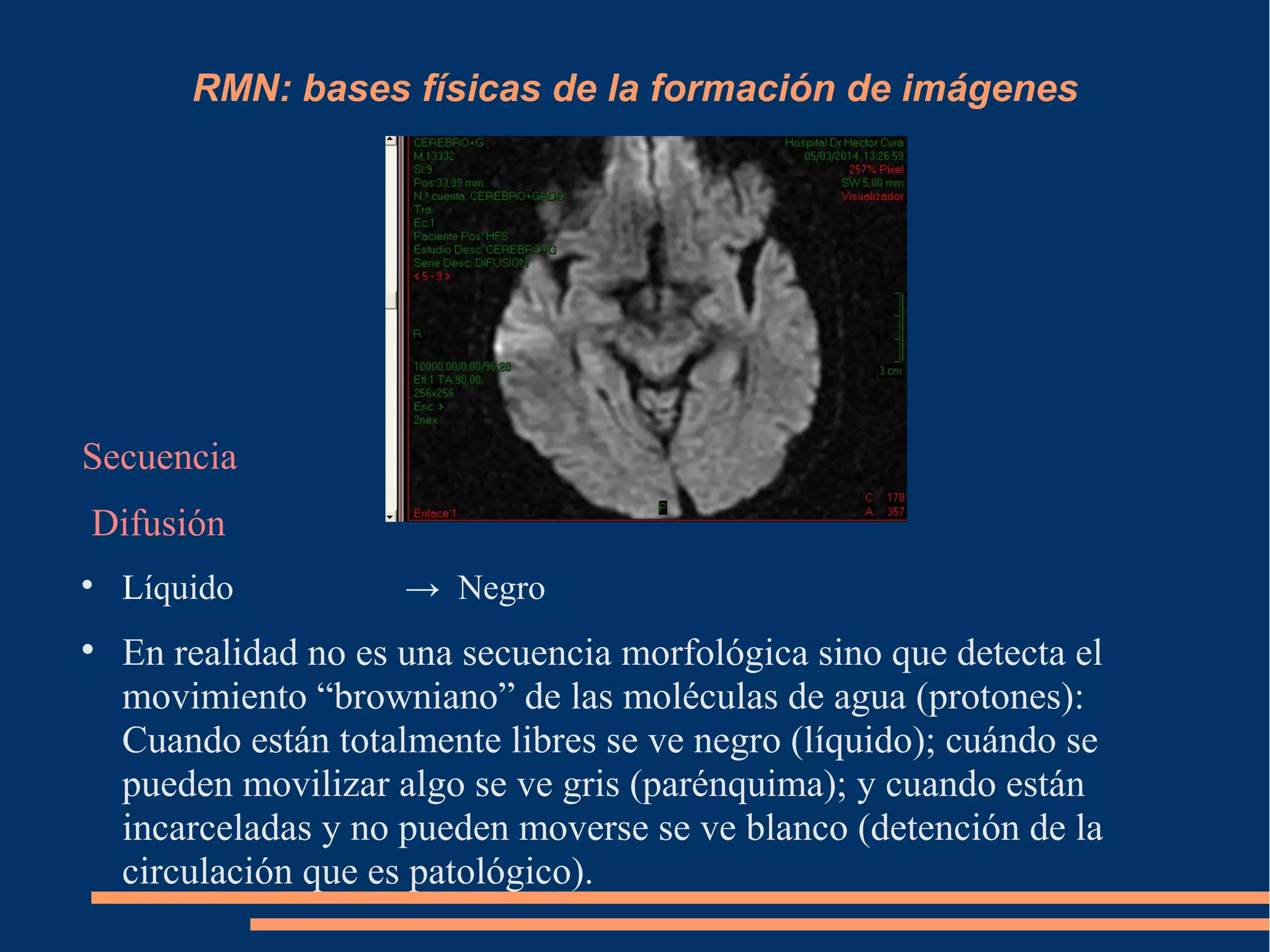 Fosa posterior rmn (1) | PDF | Brain and Nervous System Disorders ...