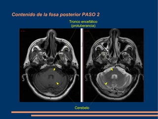 Fosa posterior rmn (1) | PDF