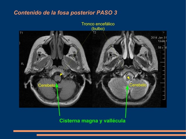 Fosa posterior rmn (1) | PDF | Brain and Nervous System Disorders ...