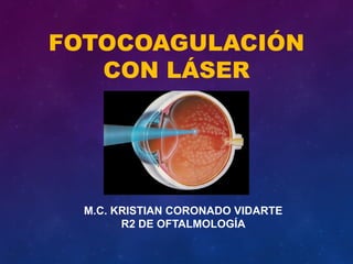 FOTOCOAGULACIÓN LASER EN LA RETINA .pptx