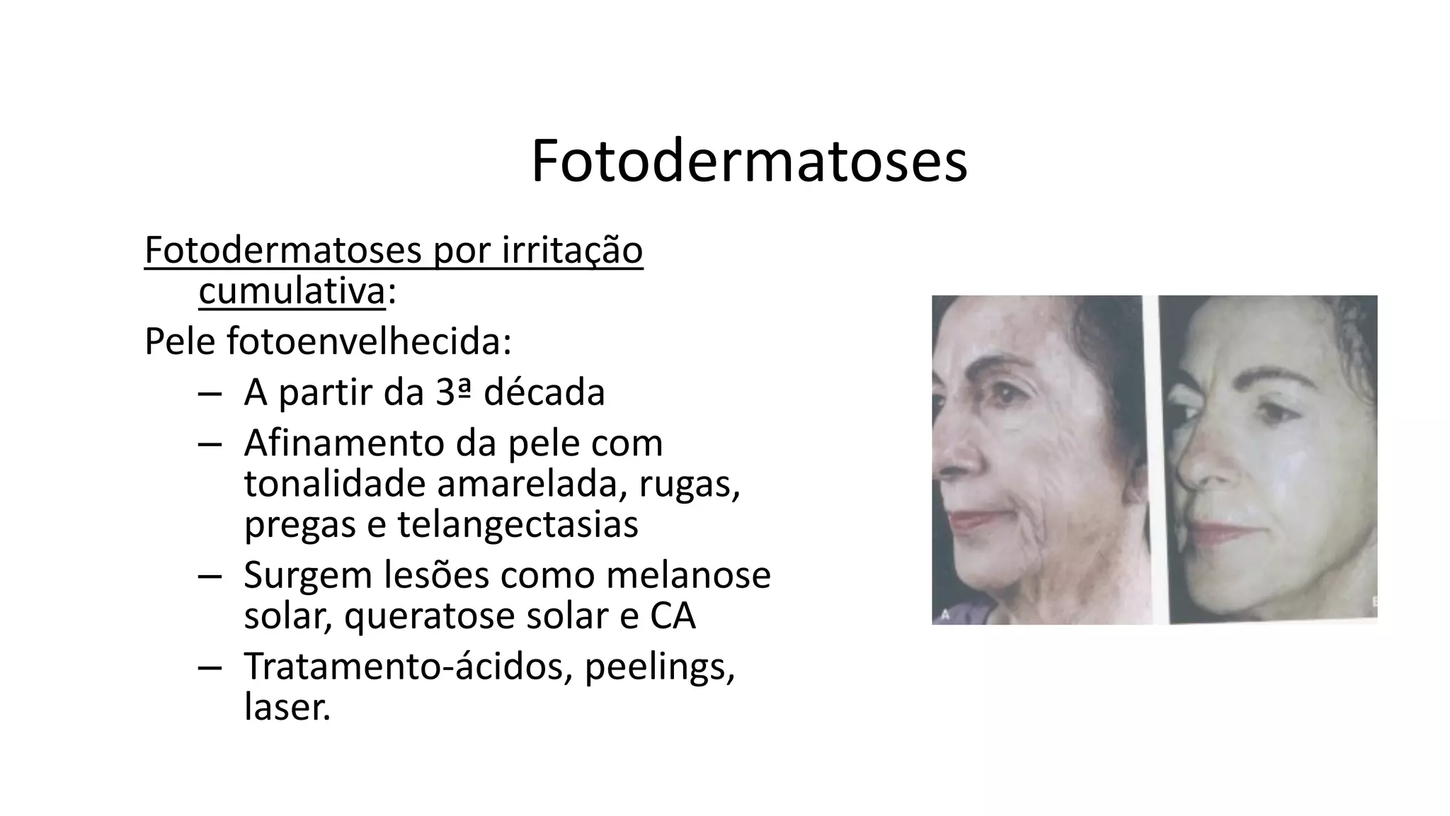 Fotodermatose