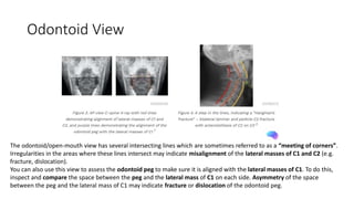 Foto polos cervical - Irfani Ryan.pptx