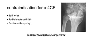 Four corner fusion | PPT