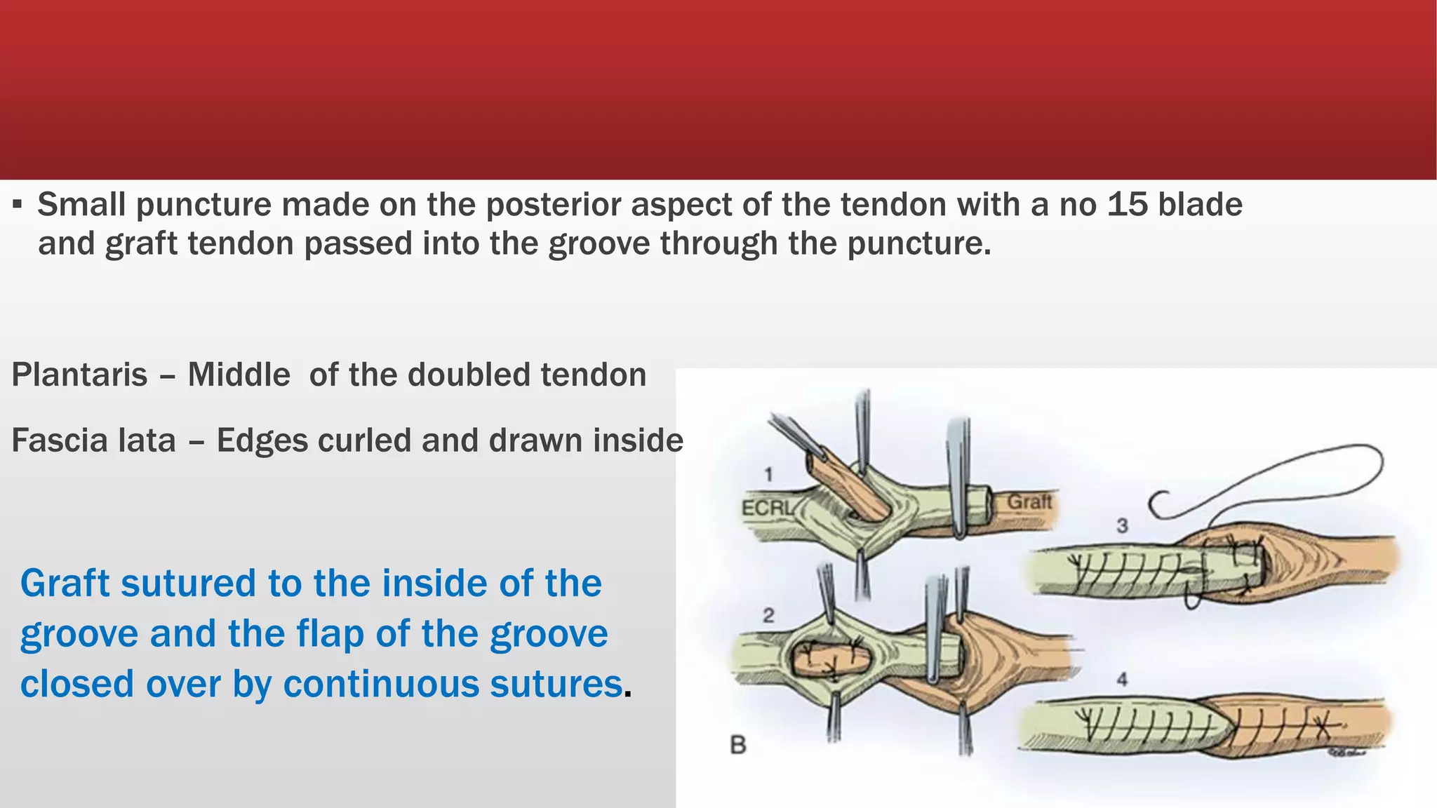ECRL Four tail tendon transfer DR VIPIN V NAIR | PPTX
