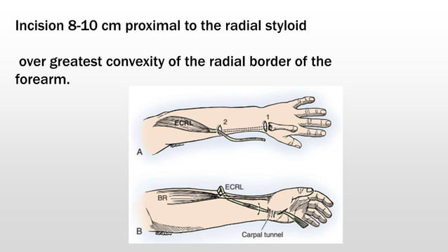 ECRL Four tail tendon transfer DR VIPIN V NAIR | PPTX