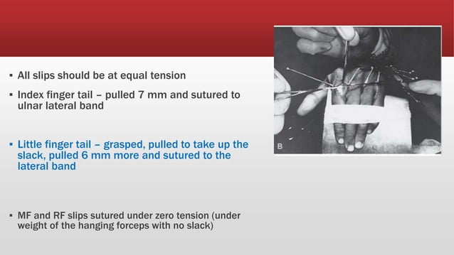 ECRL Four tail tendon transfer DR VIPIN V NAIR | PPTX
