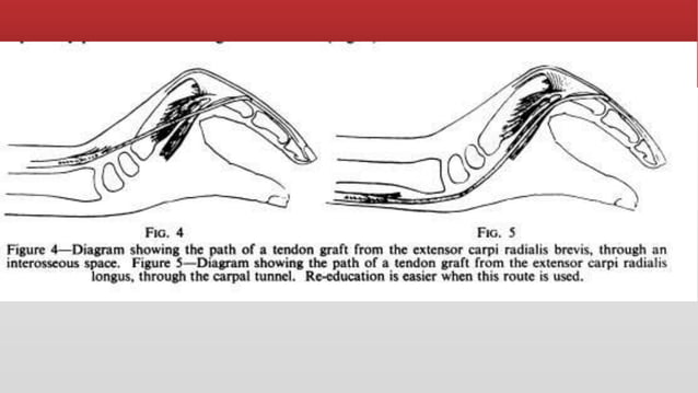 ECRL Four tail tendon transfer DR VIPIN V NAIR | PPTX
