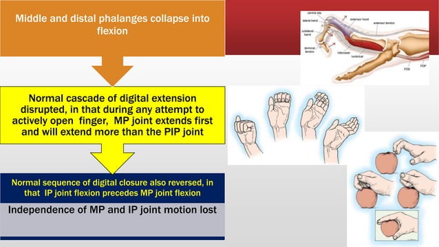 ECRL Four tail tendon transfer DR VIPIN V NAIR | PPTX