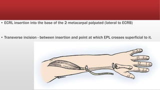 ECRL Four tail tendon transfer DR VIPIN V NAIR | PPT