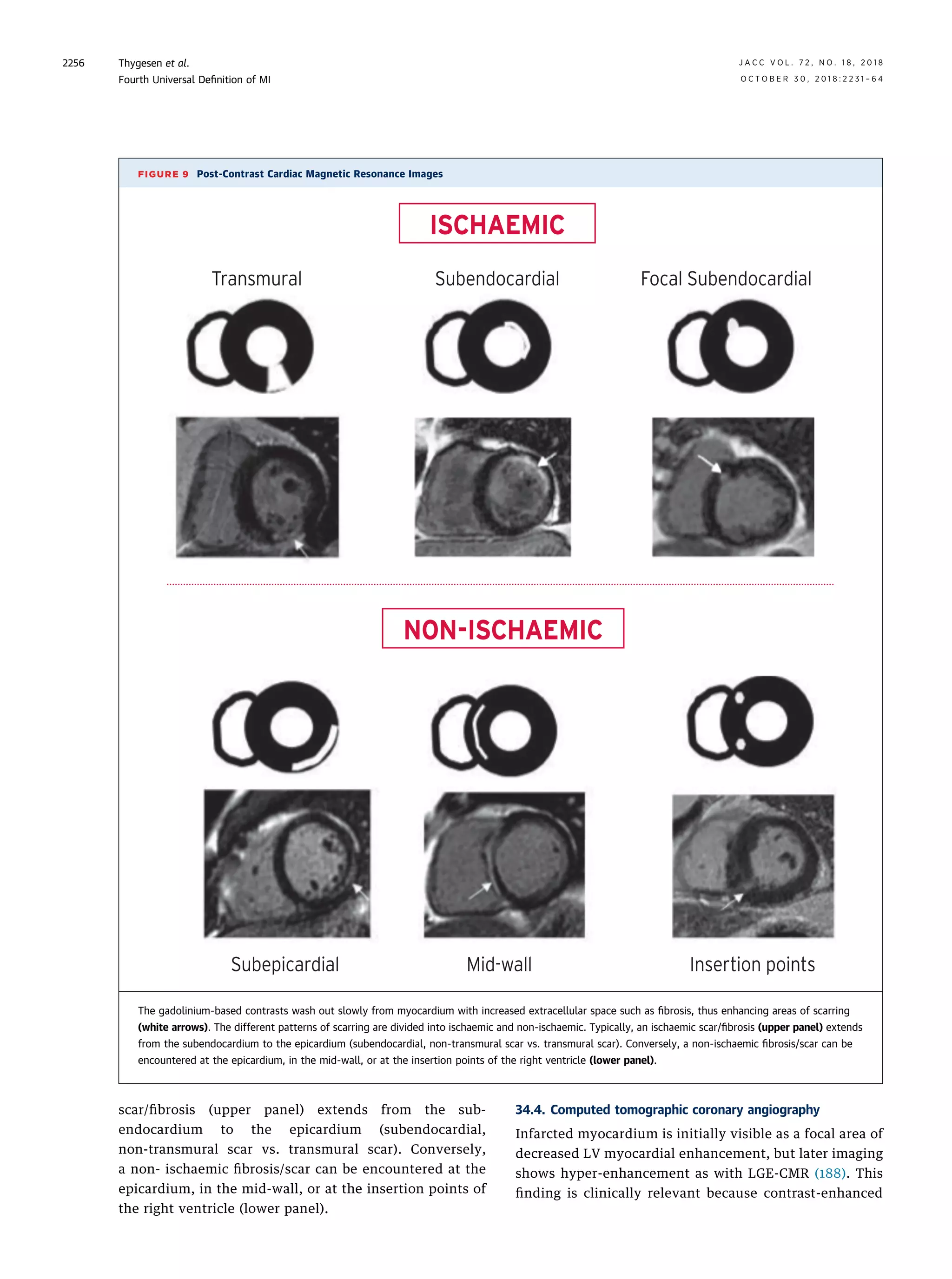 Fourth universal definition of myocardial infarction 2018 | PDF | Heart ...
