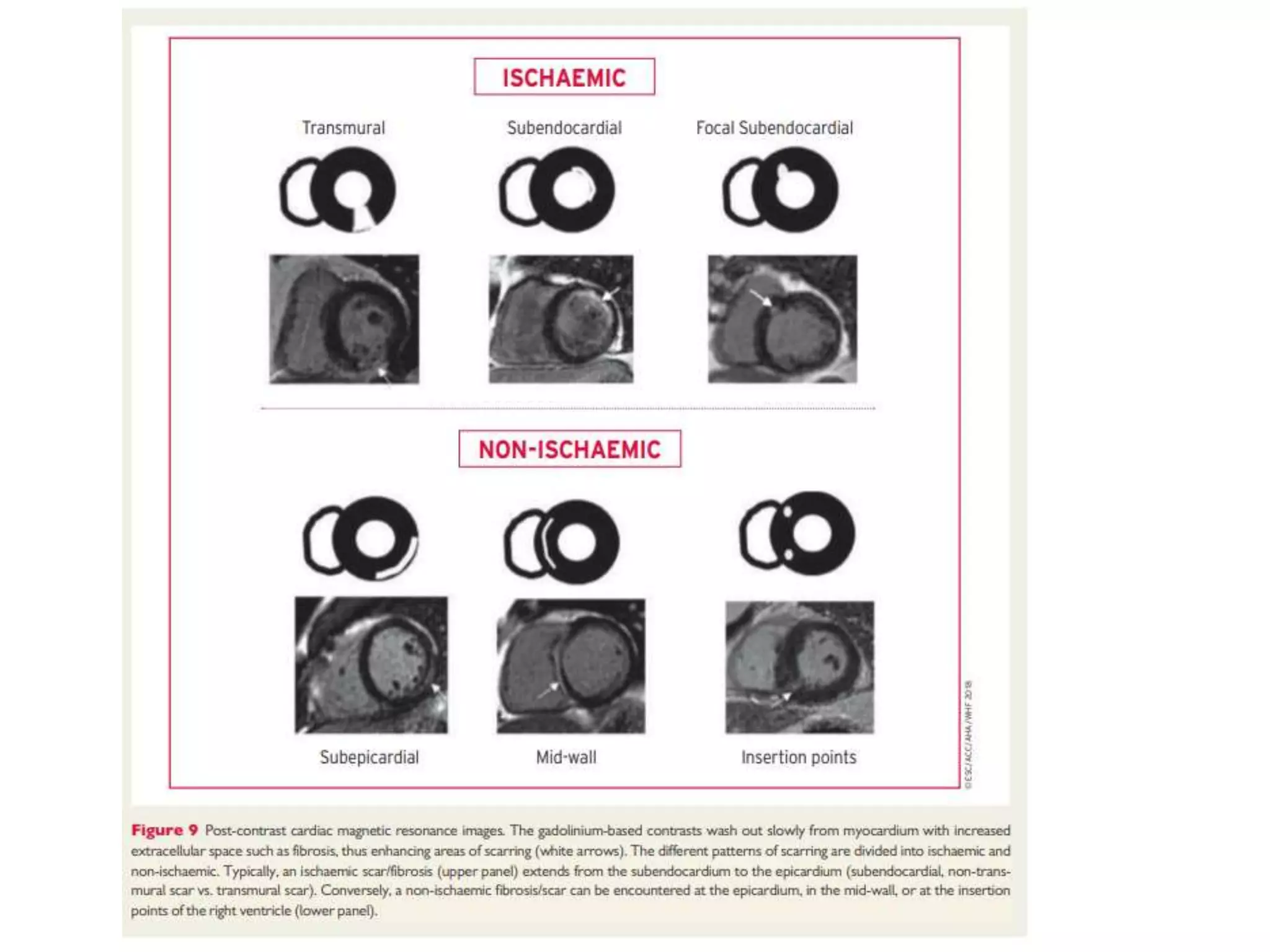 Fourth universal definition of myocardial infarction (2018) | PPTX