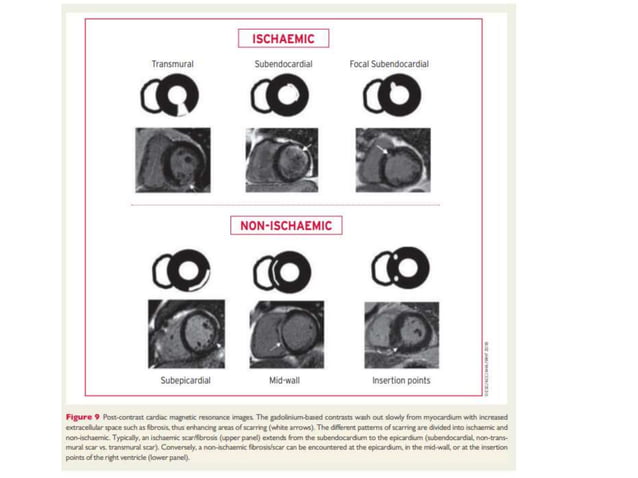 Fourth universal definition of myocardial infarction (2018) | PPTX