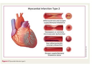 Fourth universal definition of myocardial infarction (2018) | PPTX