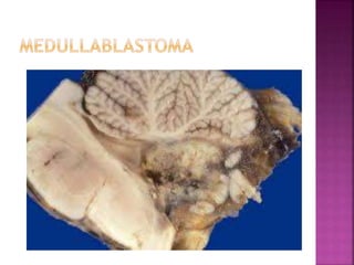 fourth ventricle.pptx