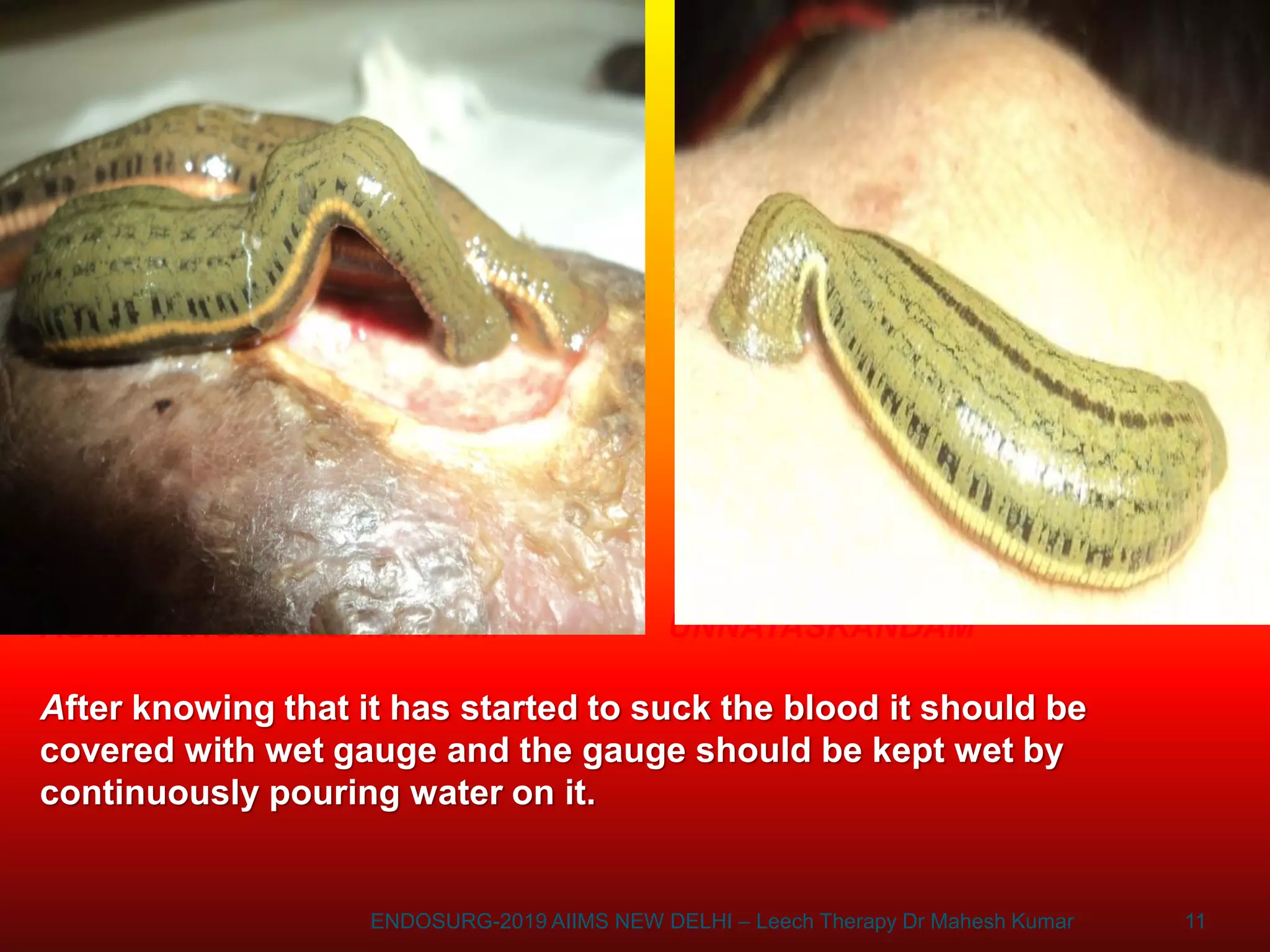 Leech and Leech therapy :scientific overview and its application | PDF