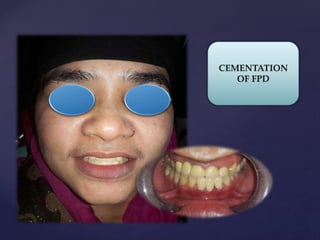 FPD | PPT