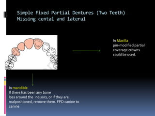 Fpd design by dr vikram | PPTX