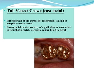 Introduction to fixed partial denture | PPT