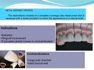 Introduction to fixed partial denture | PPT