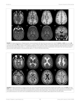 Diagnostic approach to macrocephaly in children | PDF