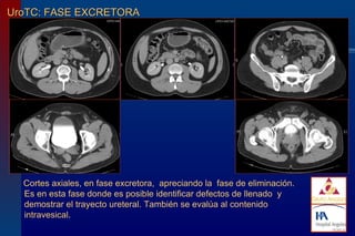 UROTOMOGRAFIA COMPUTADA | PPT