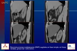 UROTOMOGRAFIA COMPUTADA | PPT