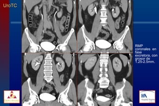 UROTOMOGRAFIA COMPUTADA | PPT