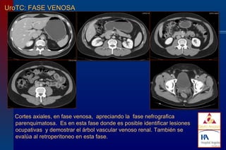 UROTOMOGRAFIA COMPUTADA | PPT