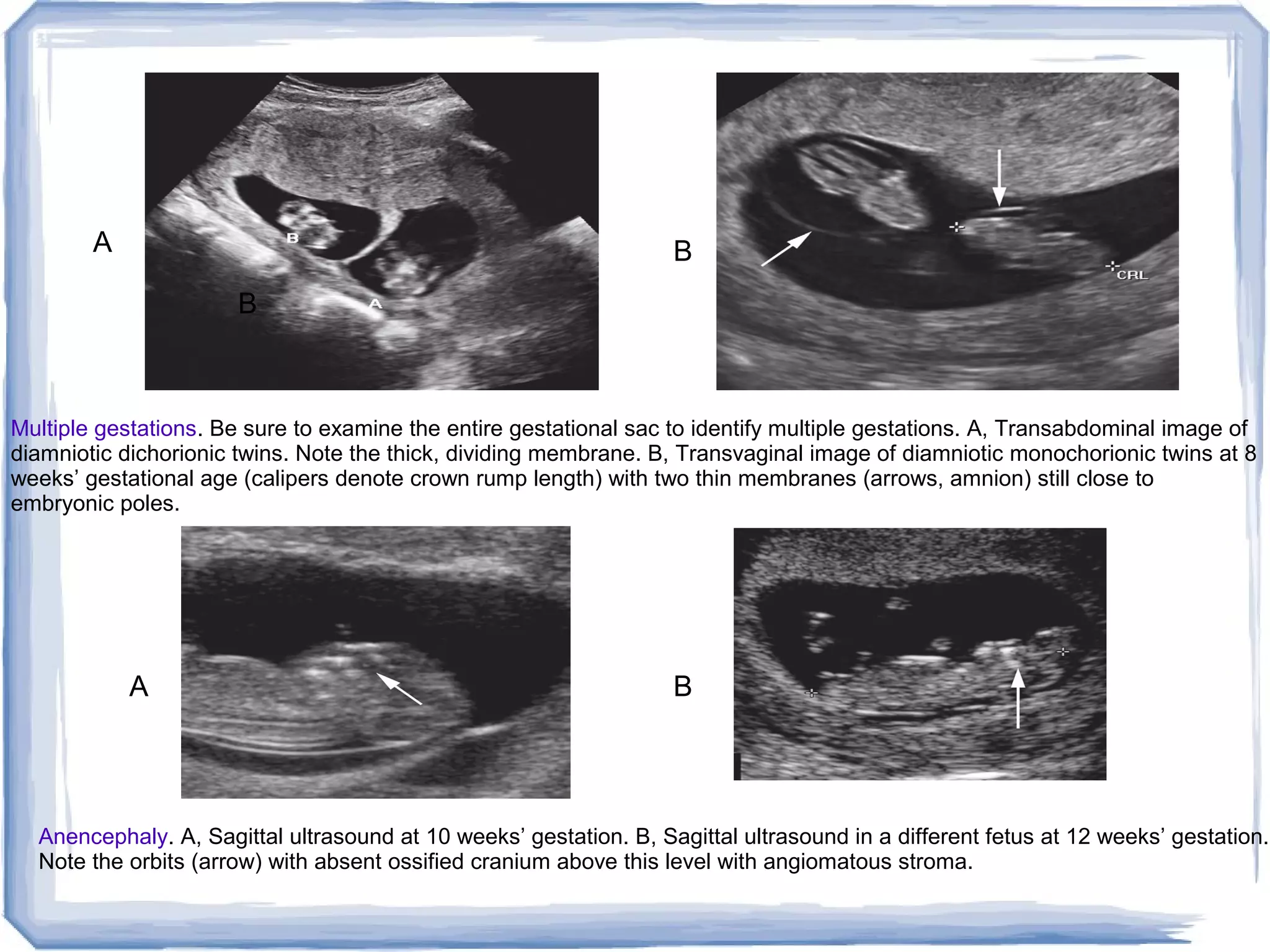 first trimester ultrasound and overview of obs imaging | PPT
