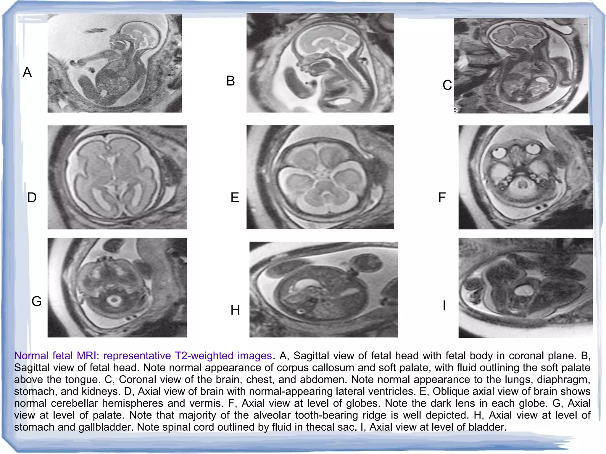 first trimester ultrasound and overview of obs imaging | PPT