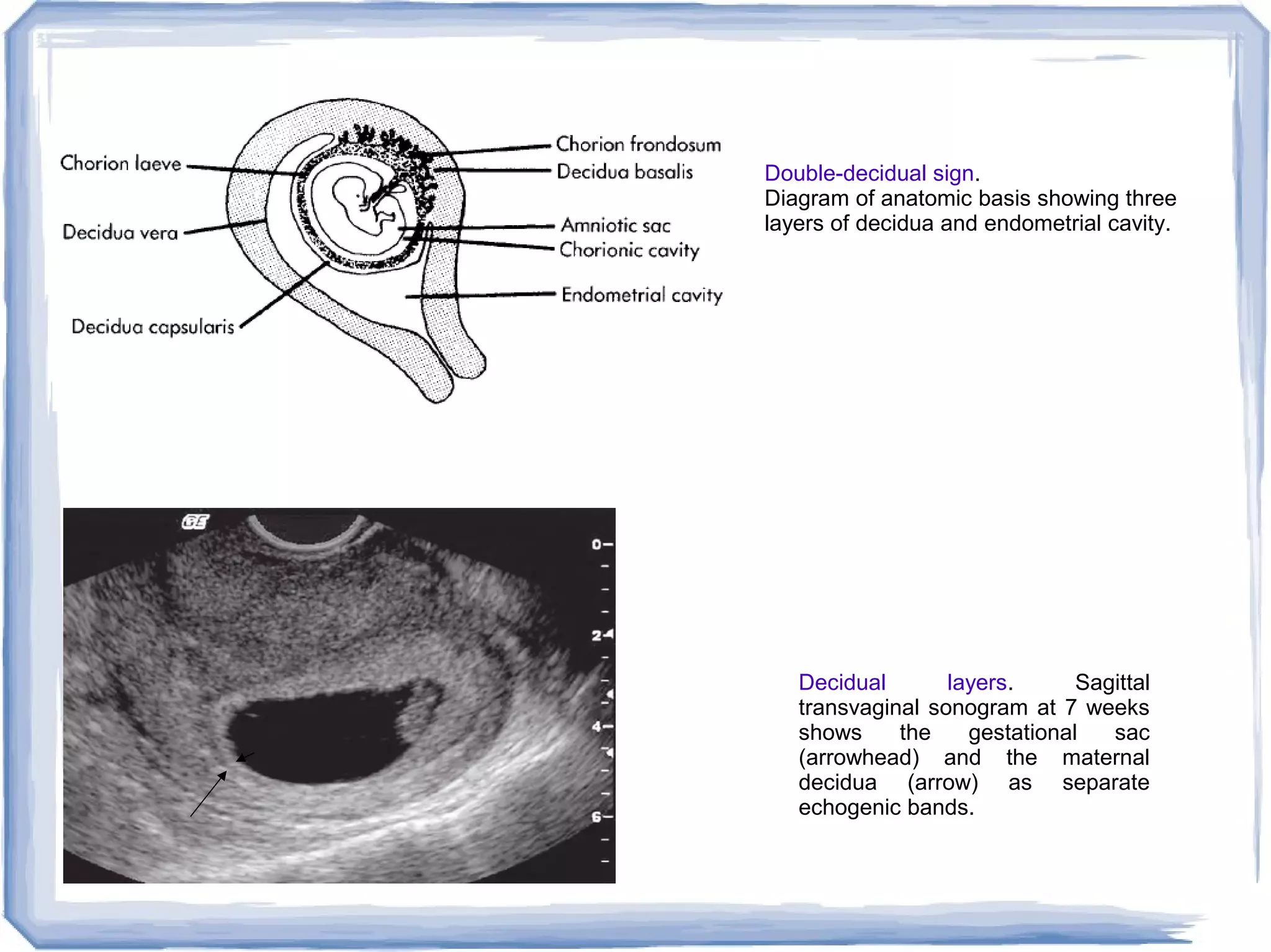 first trimester ultrasound and overview of obs imaging | PPT