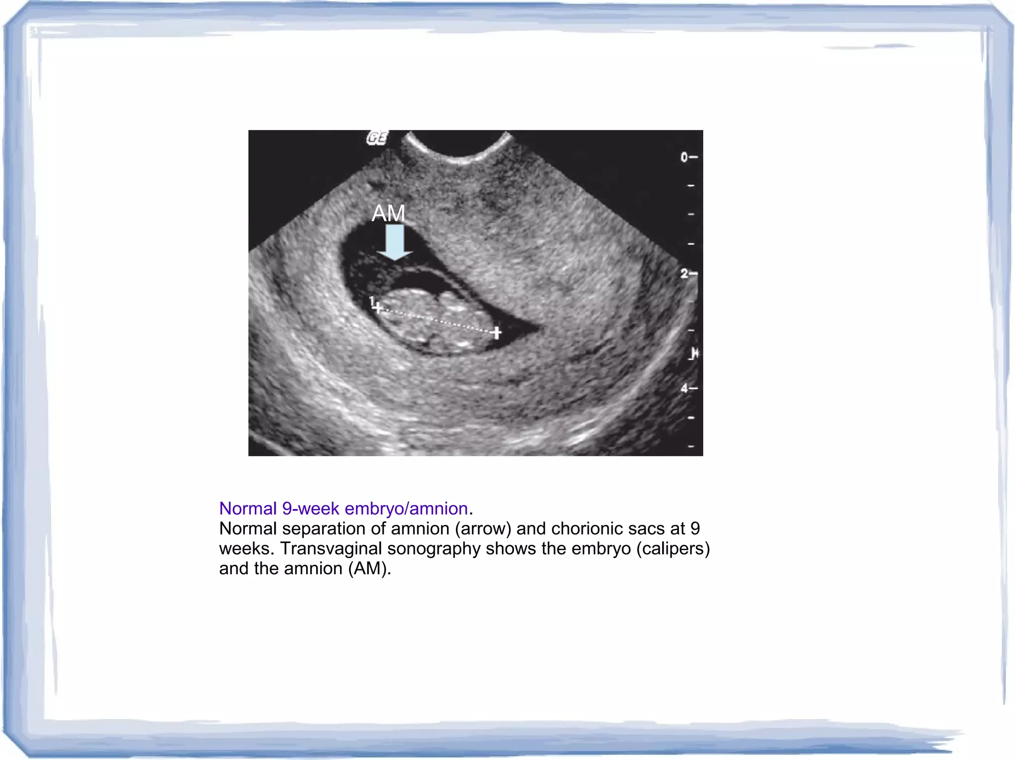 first trimester ultrasound and overview of obs imaging | PPT