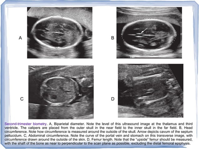 first trimester ultrasound and overview of obs imaging | PPT ...