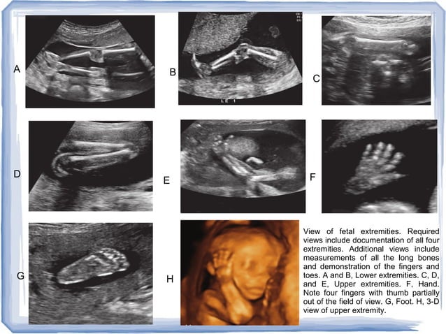 first trimester ultrasound and overview of obs imaging | PPT ...