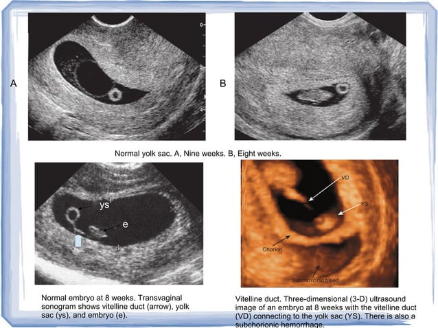 first trimester ultrasound and overview of obs imaging | PPT ...