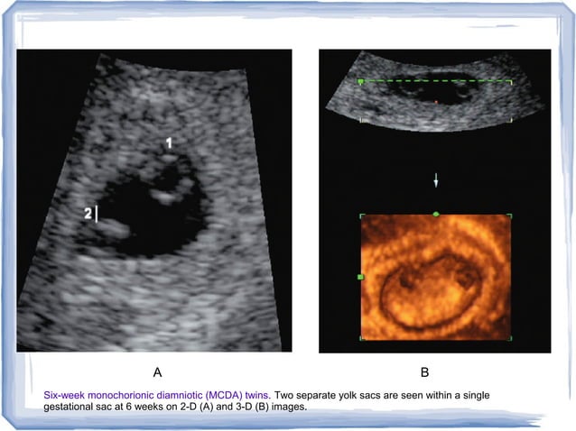 first trimester ultrasound and overview of obs imaging | PPT ...